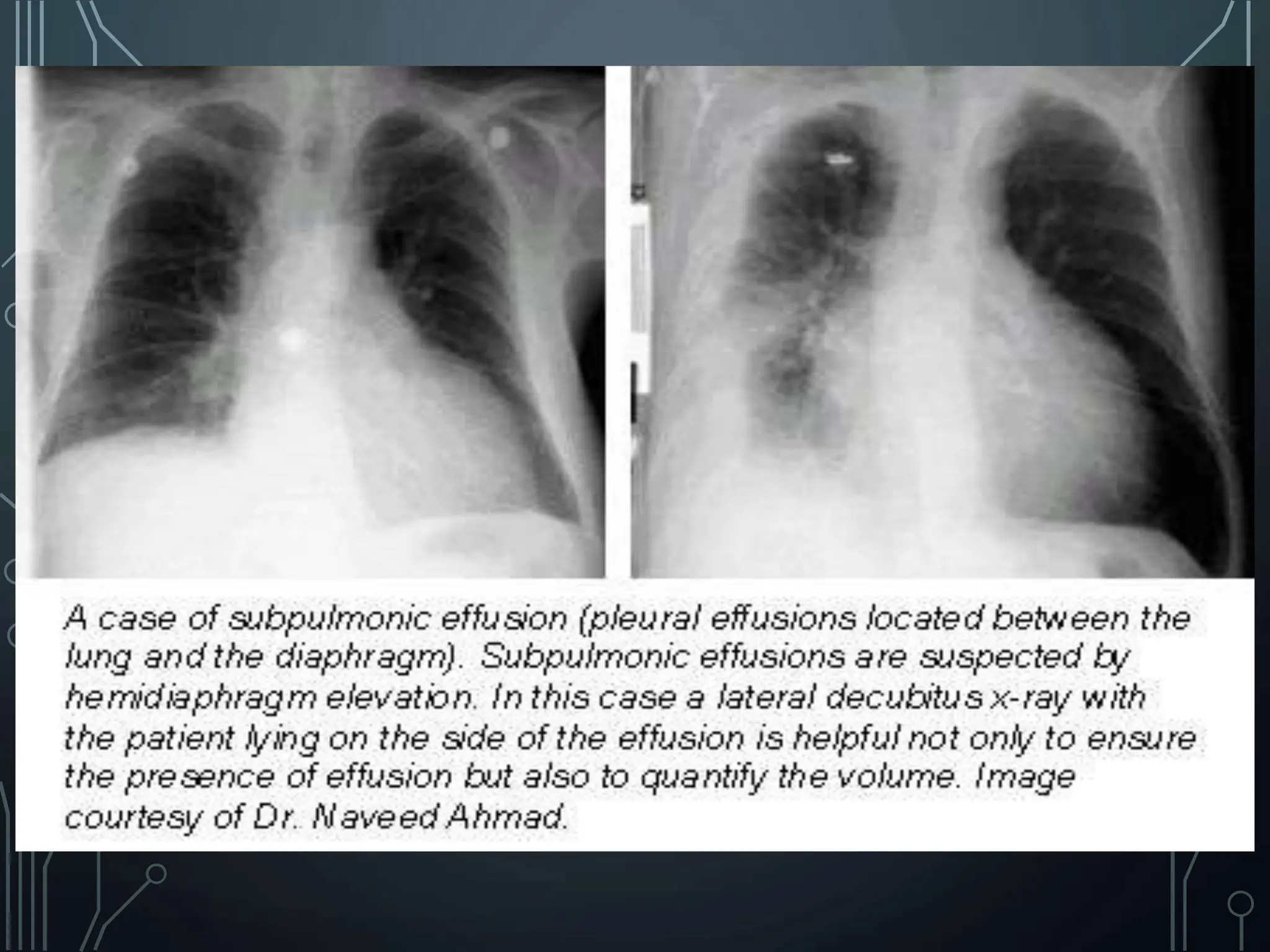 Basic Chest X ray Views - AP, PA & Lateral etc . pptx | PPTX