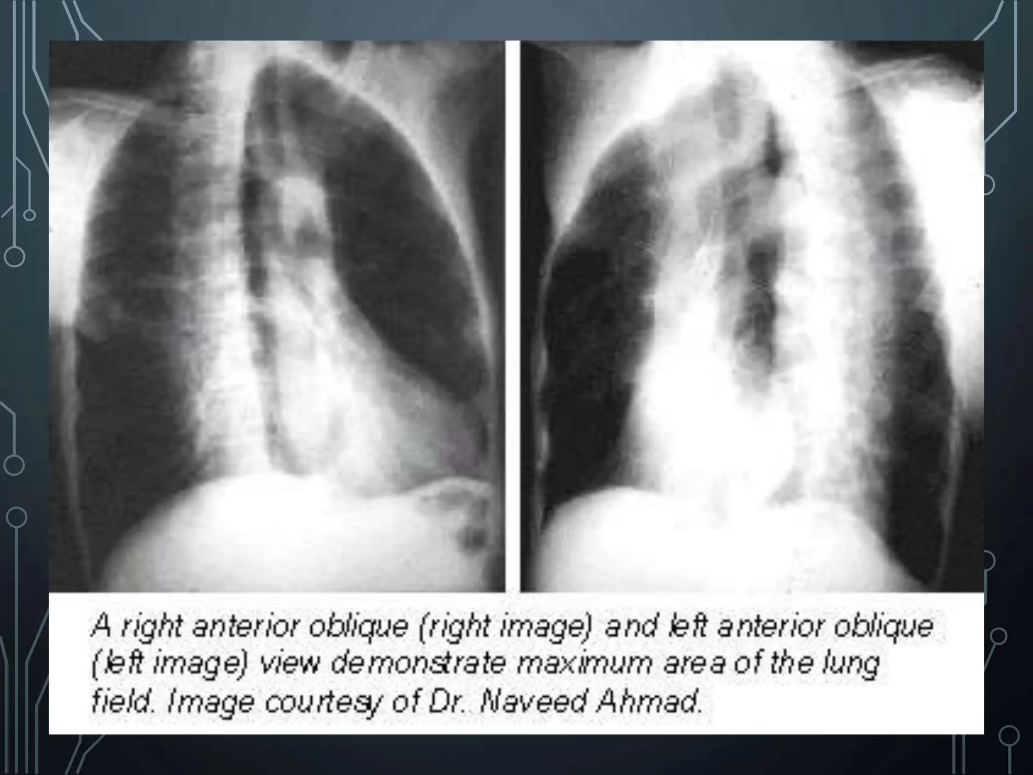 Basic Chest X ray Views - AP, PA & Lateral etc . pptx | PPTX