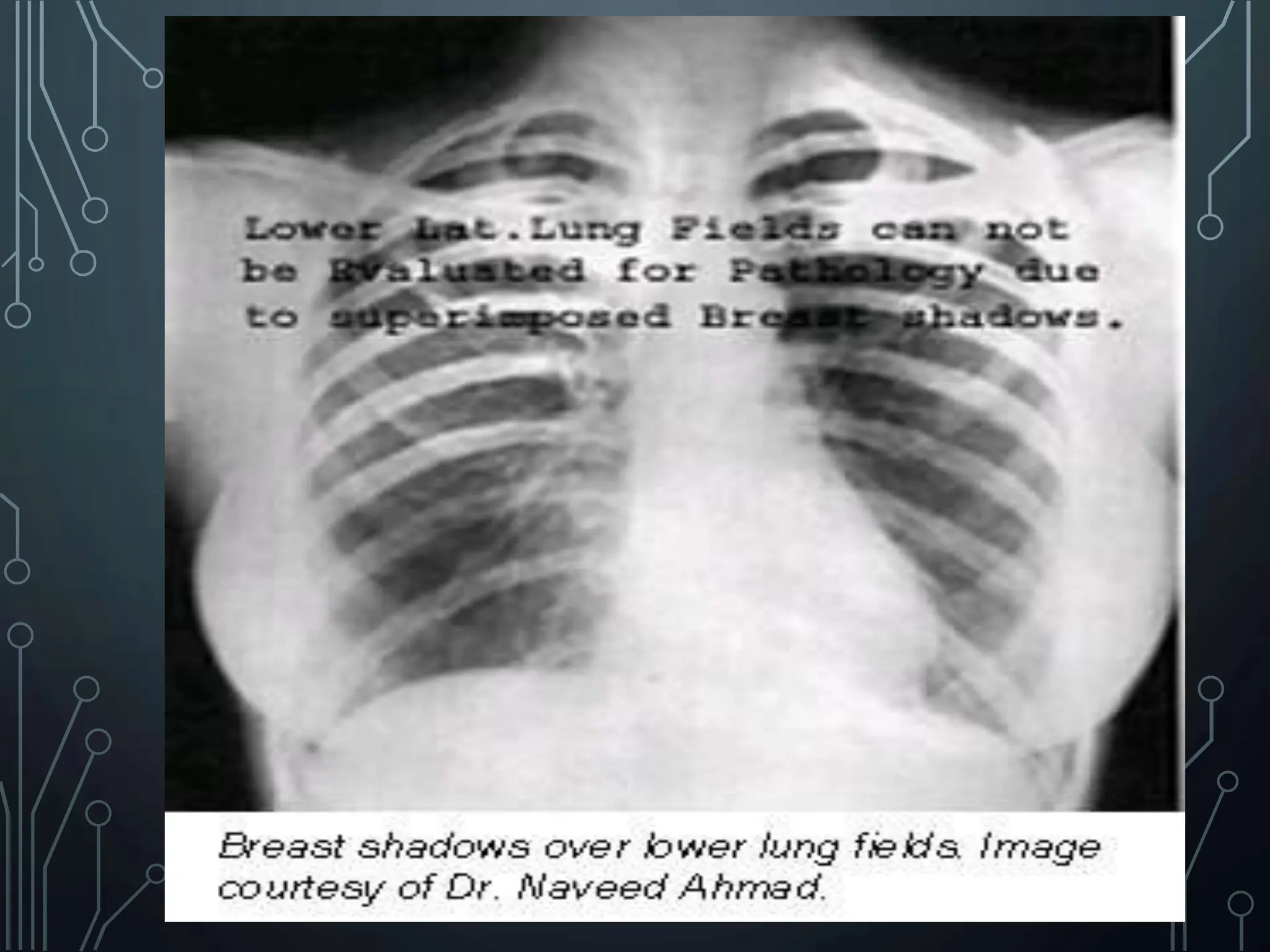 Basic Chest X ray Views - AP, PA & Lateral etc . pptx | PPTX