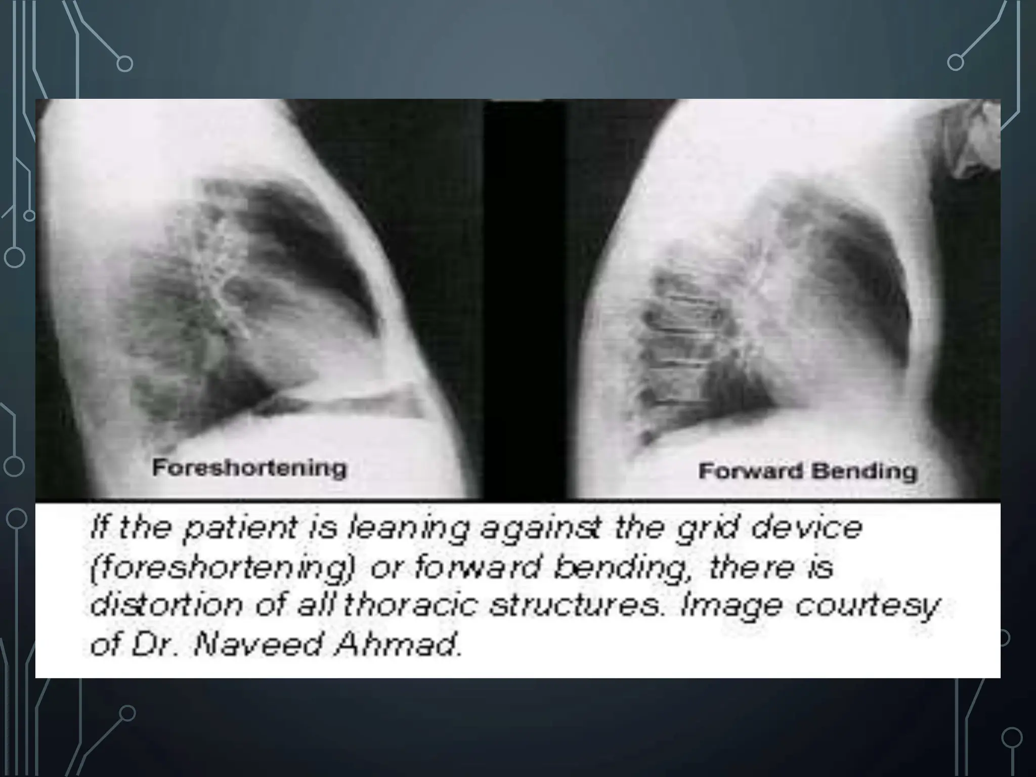 Basic Chest X ray Views - AP, PA & Lateral etc . pptx | PPTX