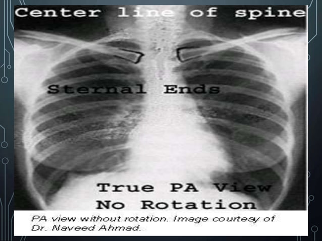 Basic Chest X ray Views - AP, PA & Lateral etc . pptx | PPTX