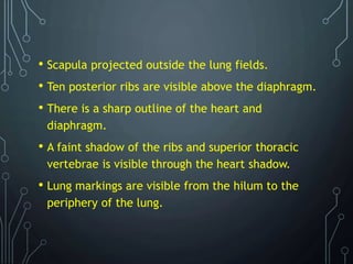 Basic Chest X ray Views - AP, PA & Lateral etc . pptx | PPTX