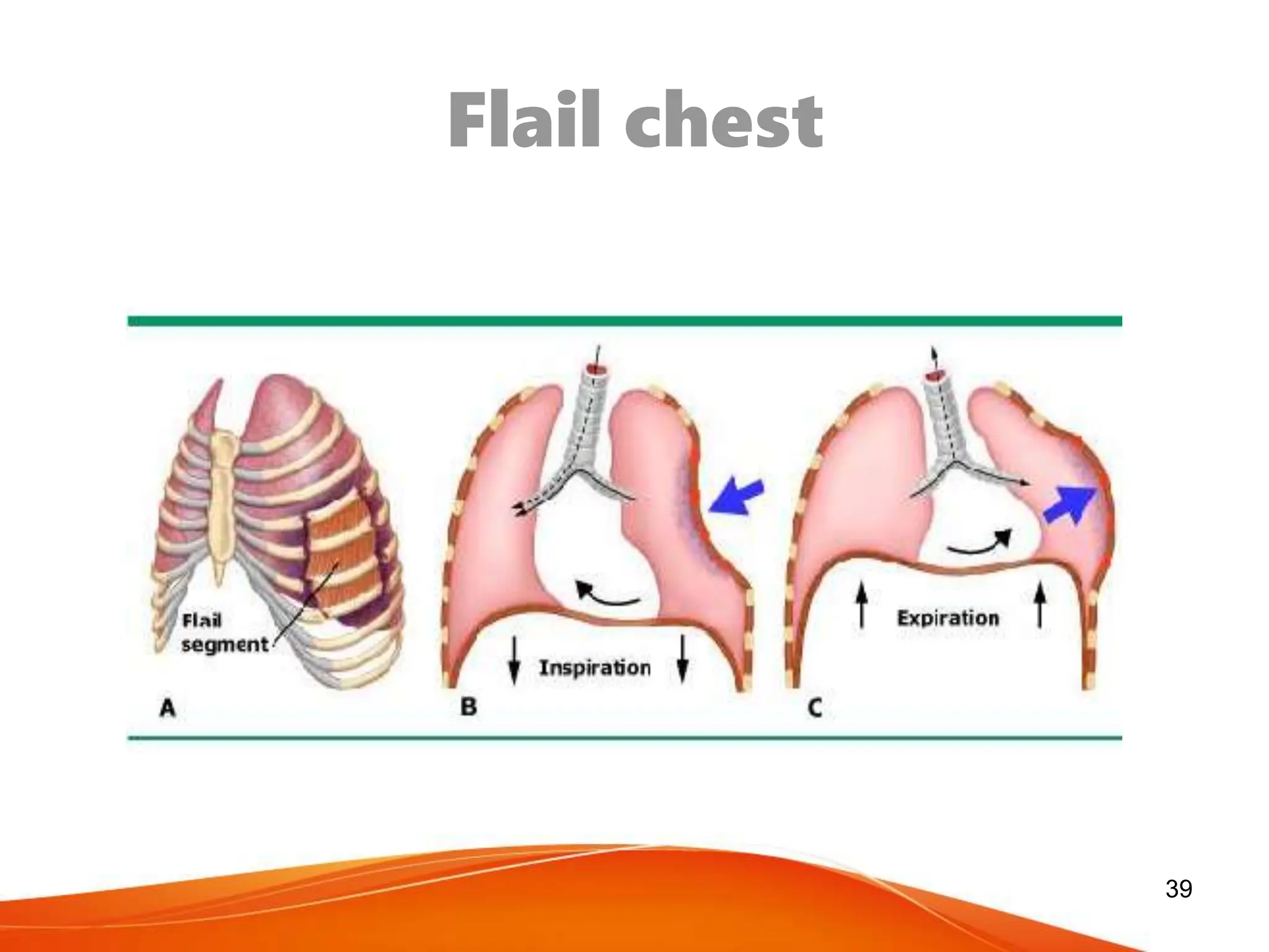 Chet Injuries ,chest tube and ETT by me.pptx