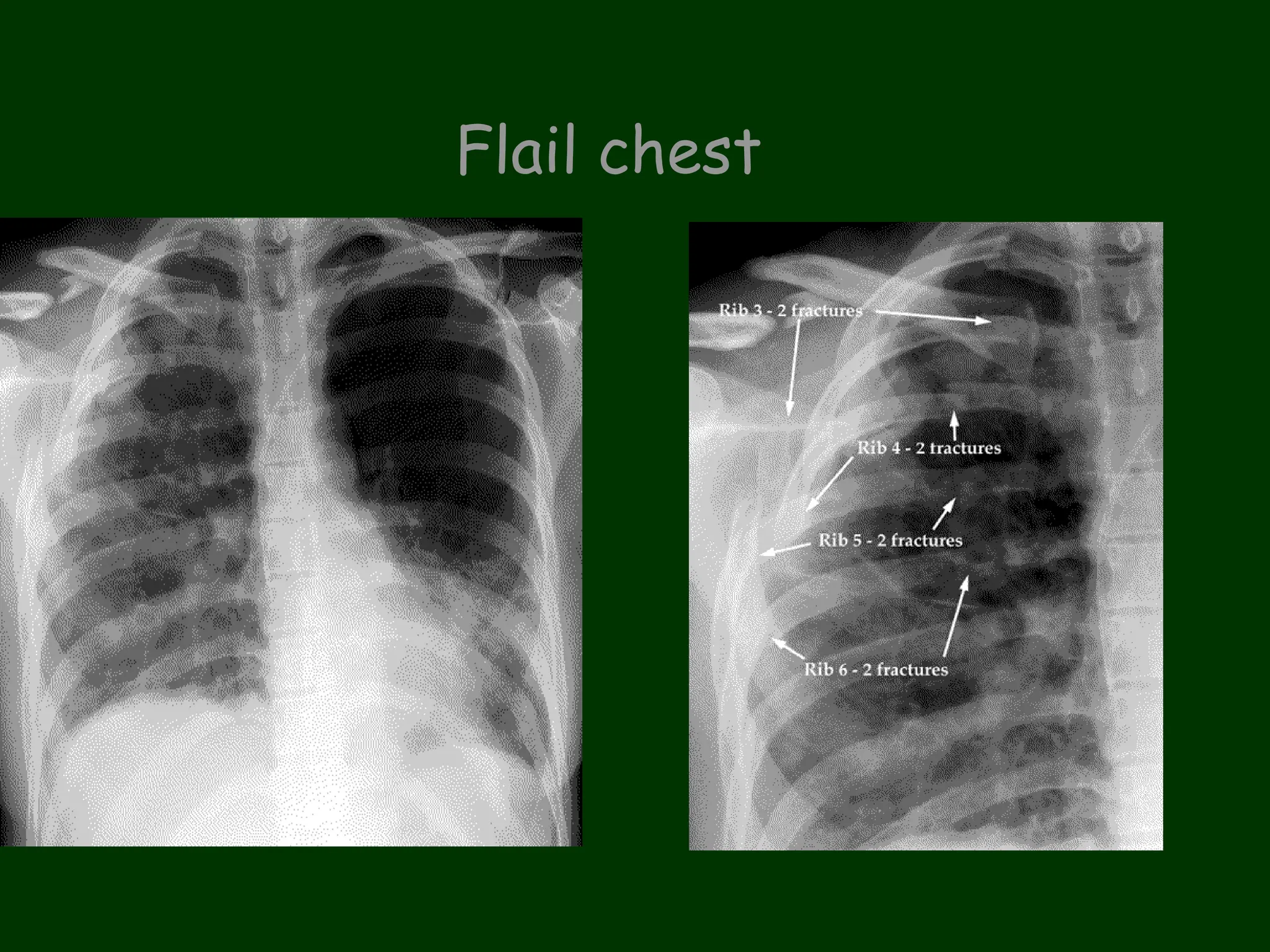 Chet Injuries ,chest tube and ETT by me.pptx