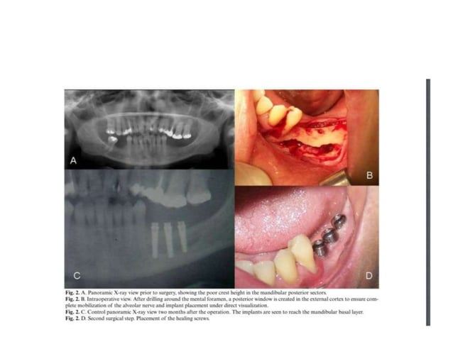 inferior alveolar nerve lateralization | PPTX | Dental Health ...