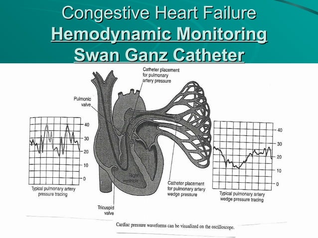congestive heart failure power point(ppt) | PPT