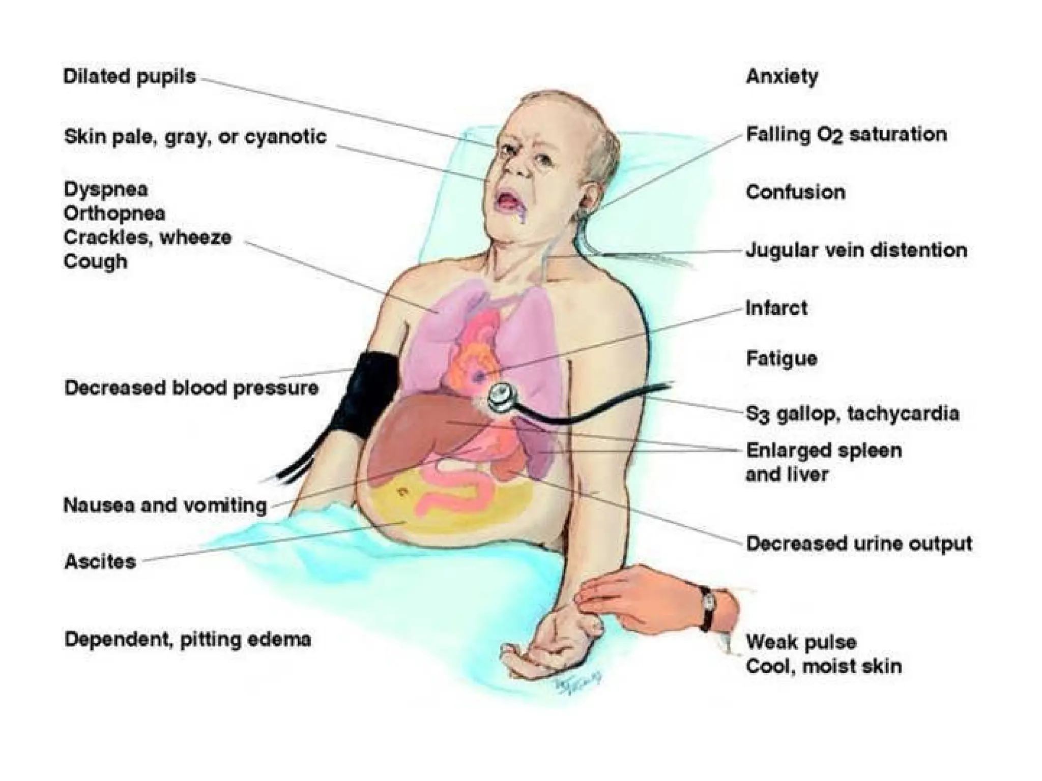 CHf CHf CHf heart signs and symptoms pptx | PPTX