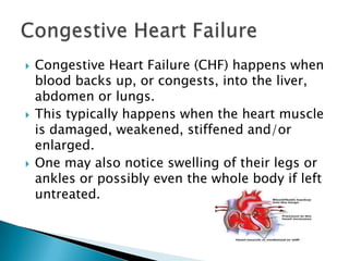 CHF Patient Education | PPTX
