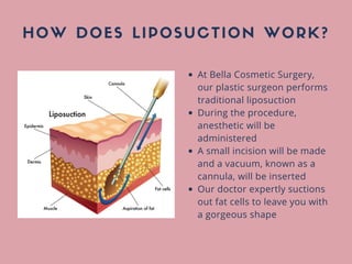 Frequently Asked Questions About Liposuction | PPT