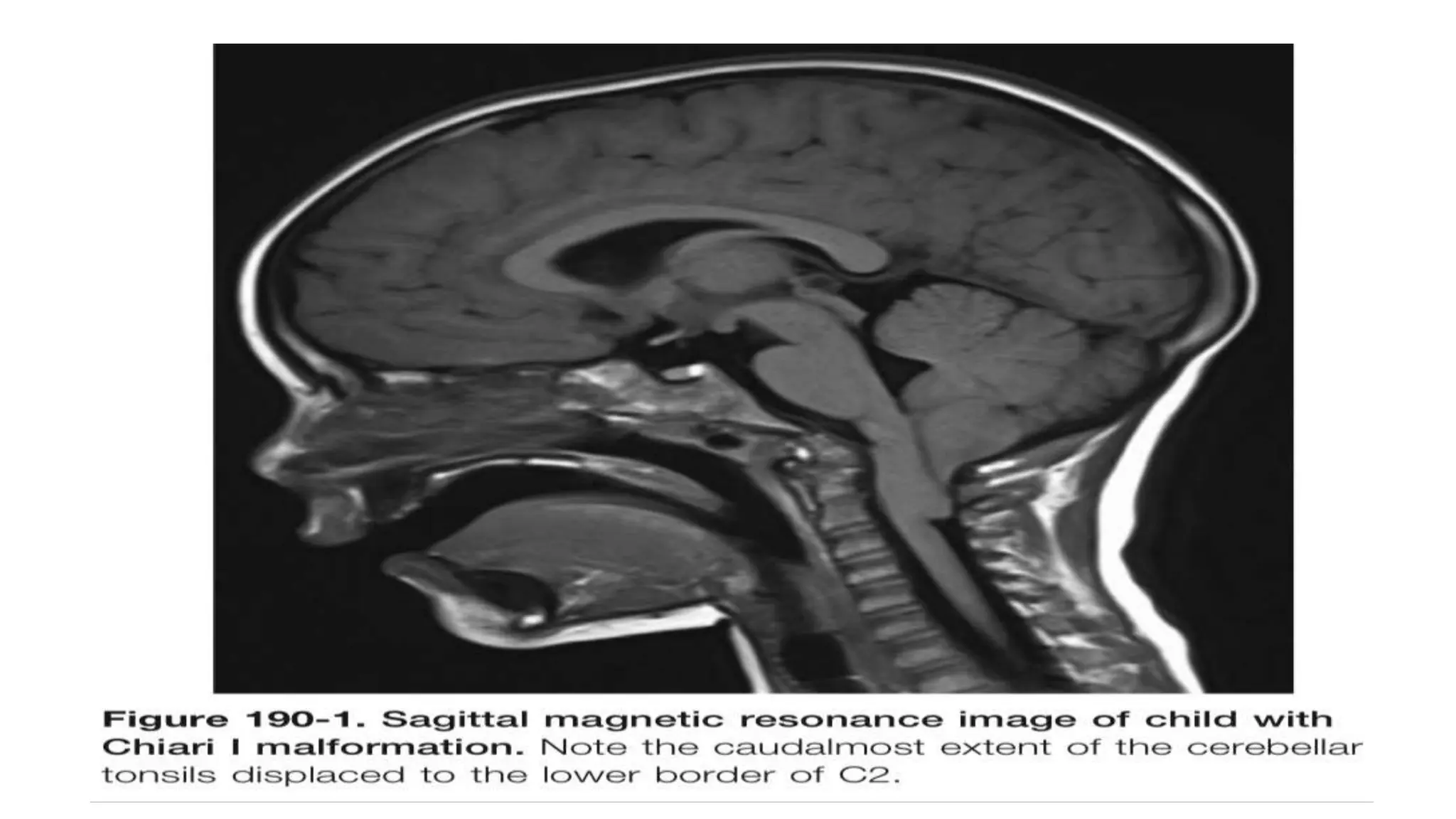 Arnold chiari malformation and types.pptx