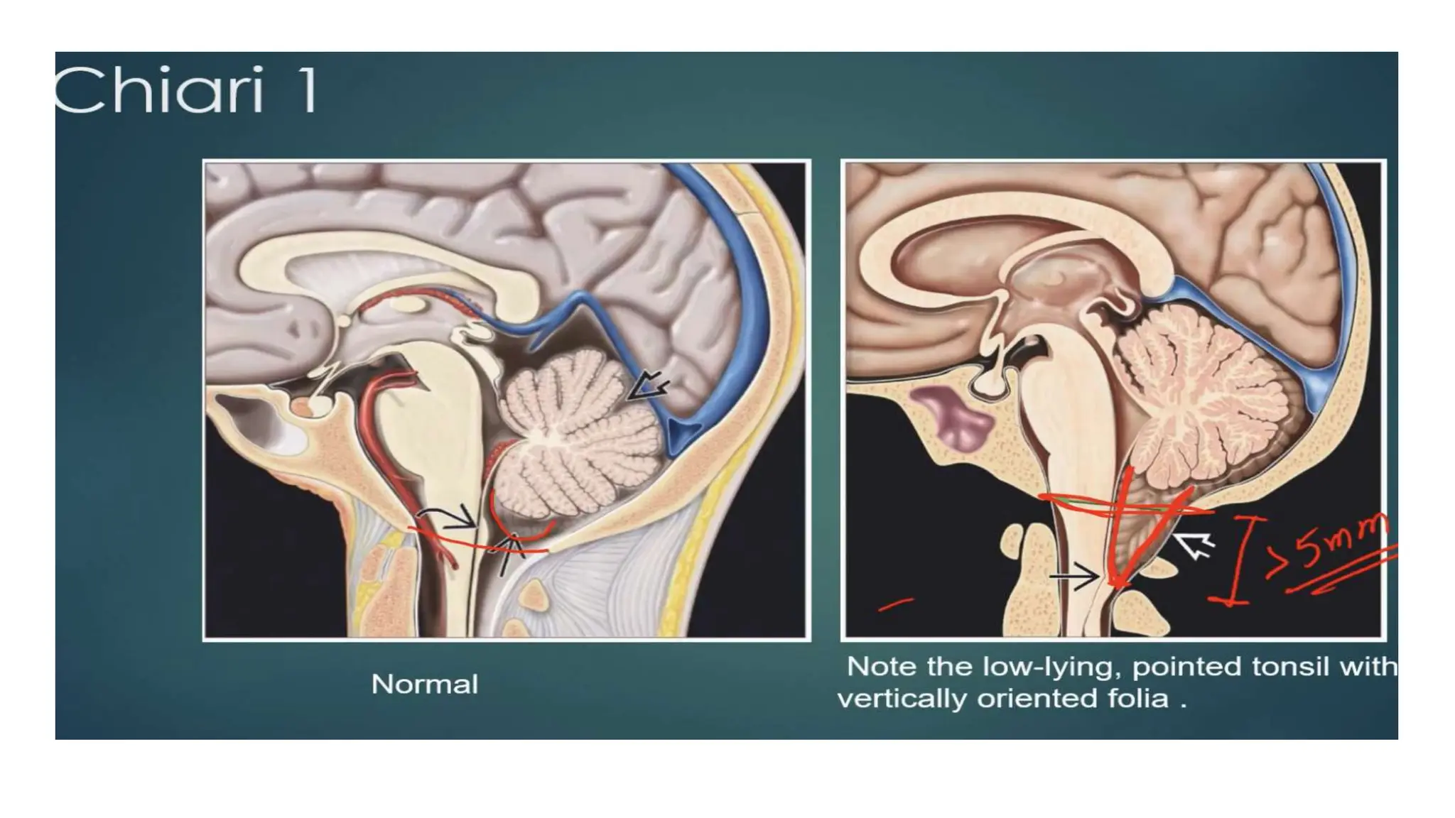Arnold chiari malformation and types.pptx