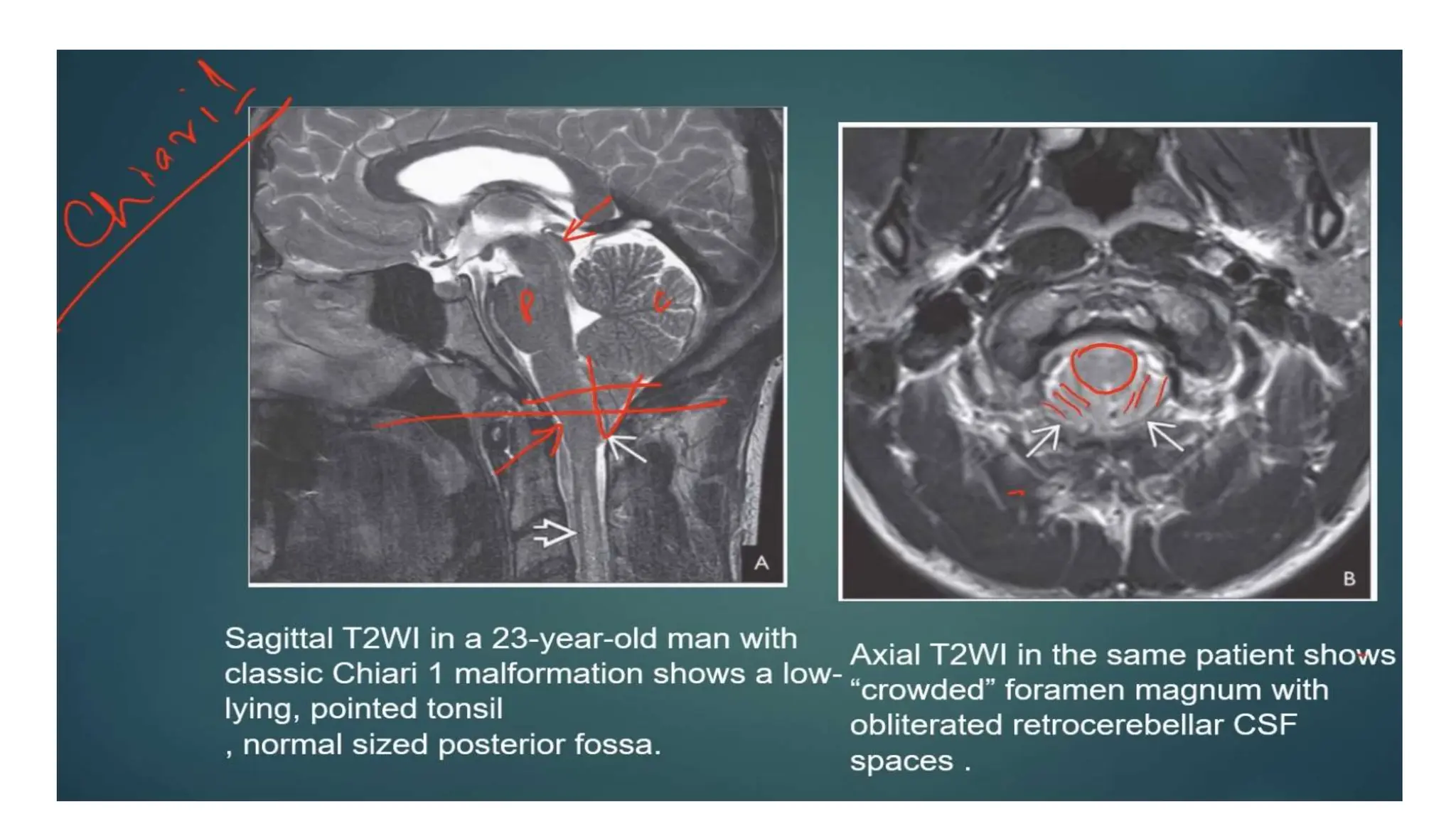 Arnold chiari malformation and types.pptx