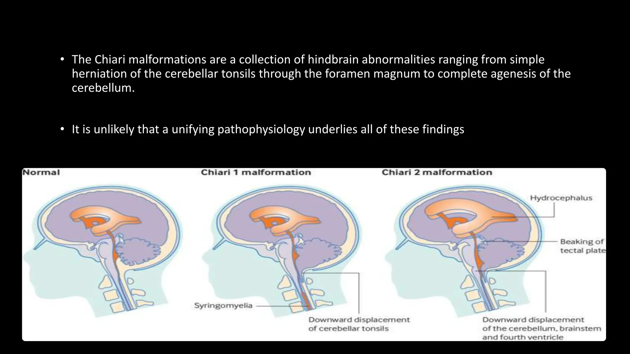 Arnold chiari malformation and types.pptx