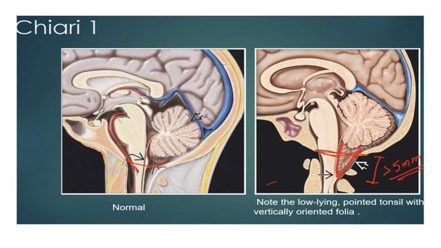Arnold chiari malformation and types.pptx | Brain and Nervous System ...