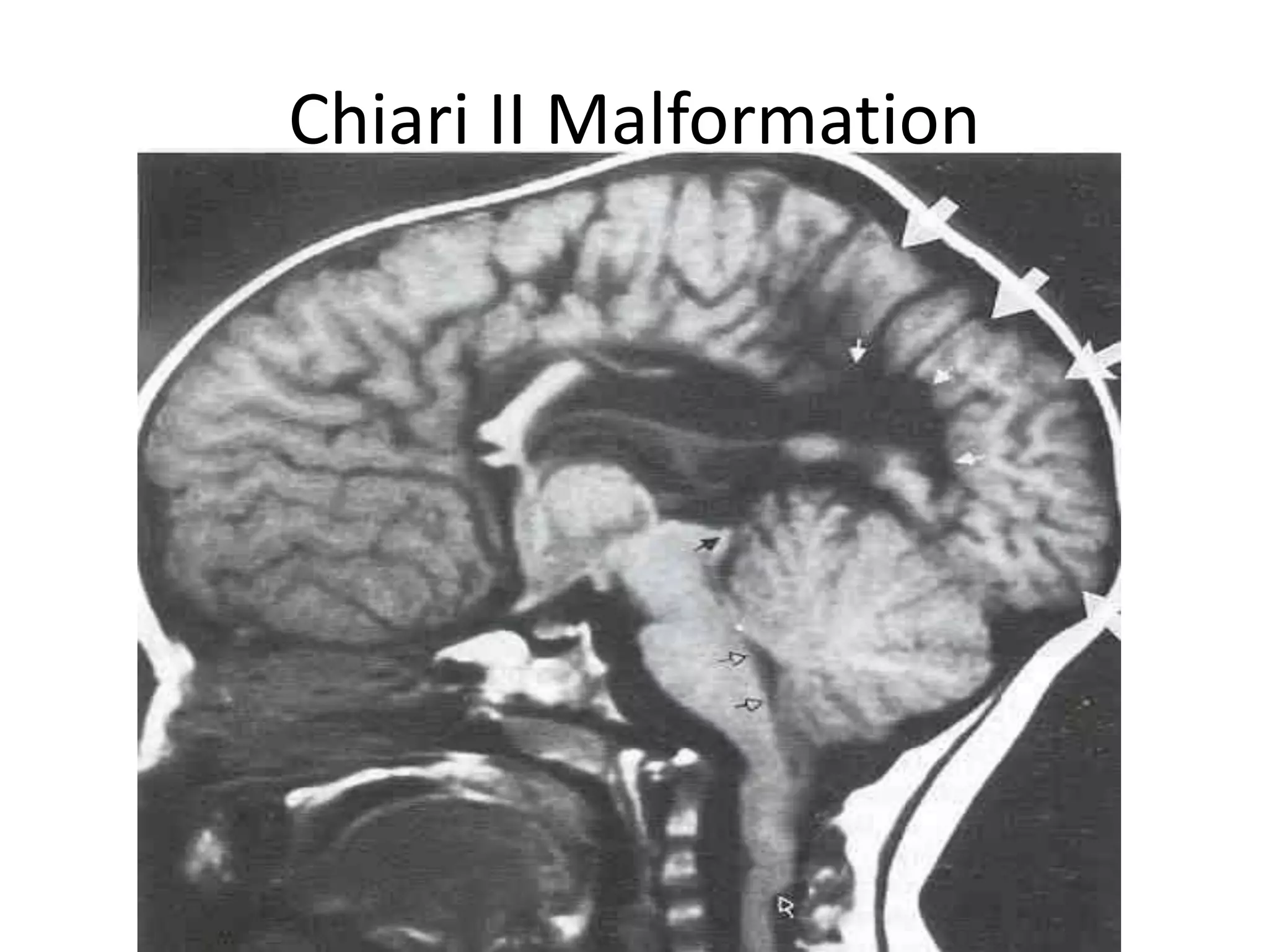 Chiari malformation | PPTX