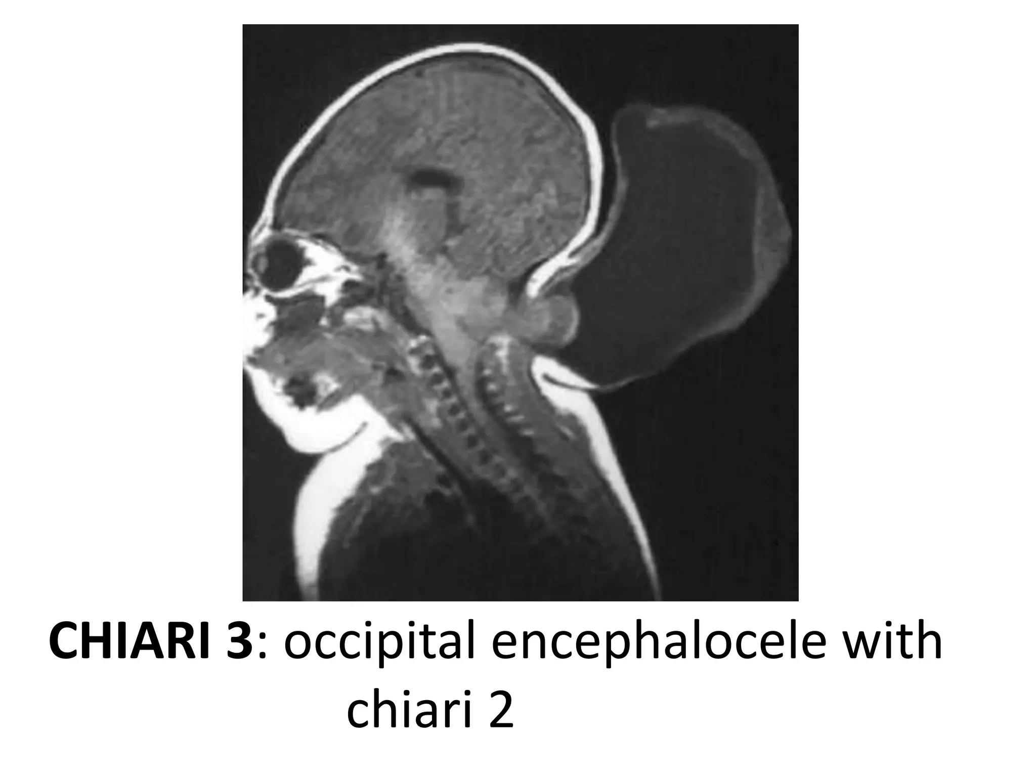 Chiari malformation | PPTX