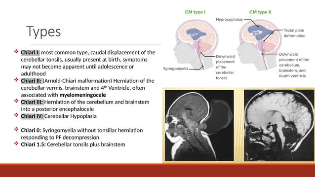 Chiari Malformation (an overview).pptx