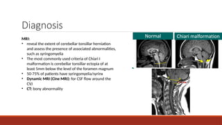 Chiari Malformation (an overview).pptx