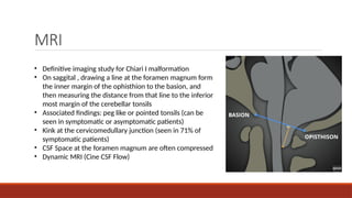 Chiari Malformation (an overview).pptx