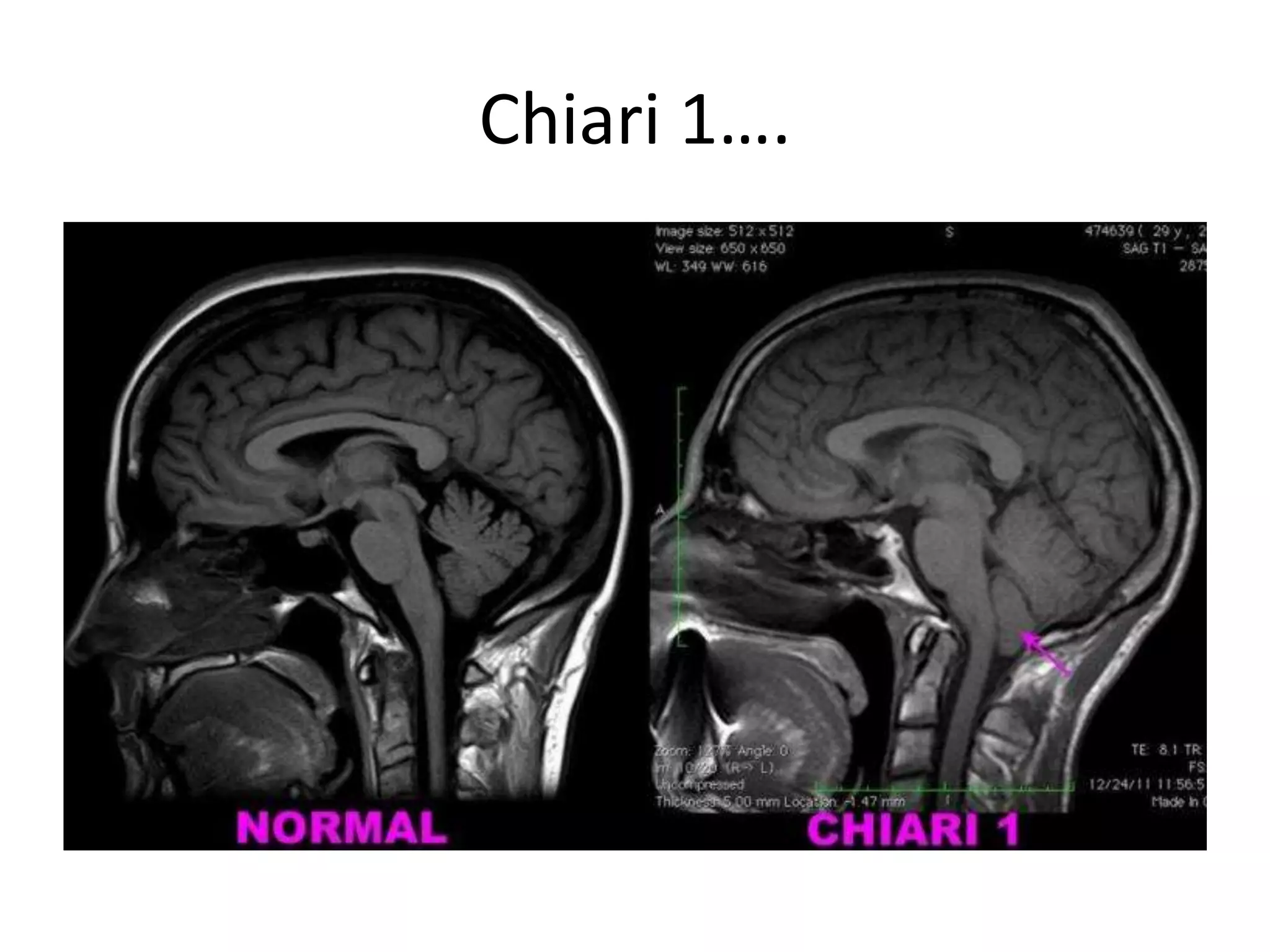 chiari malformation mukesh.pptx