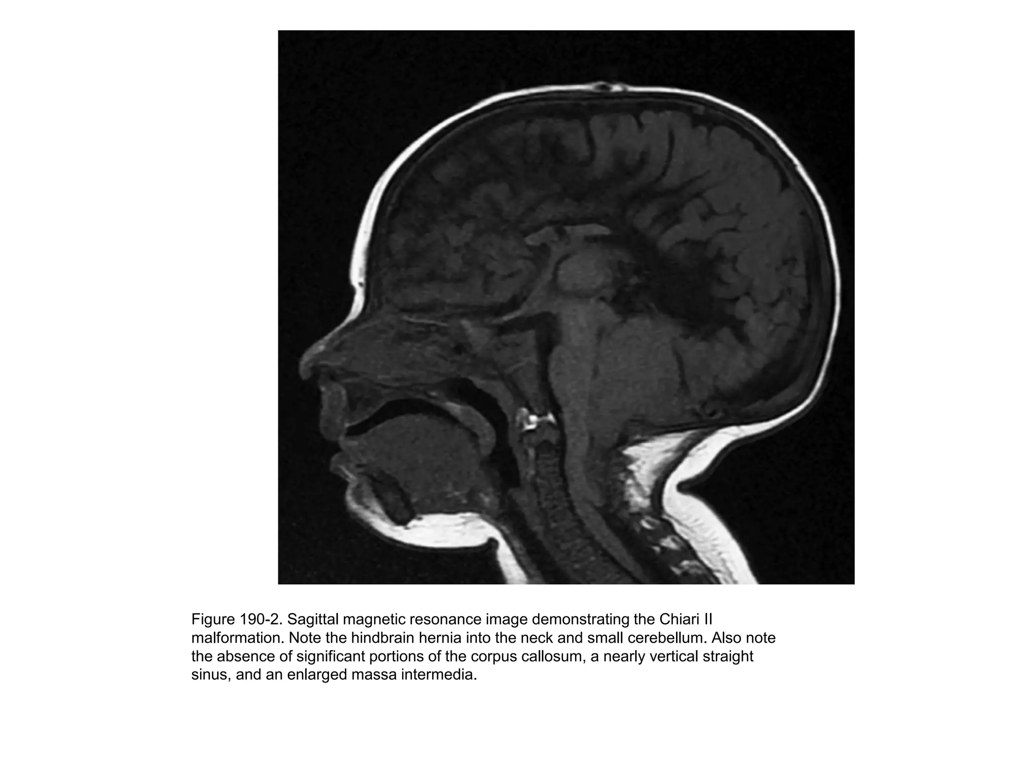 chiari malformation mukesh.pptx