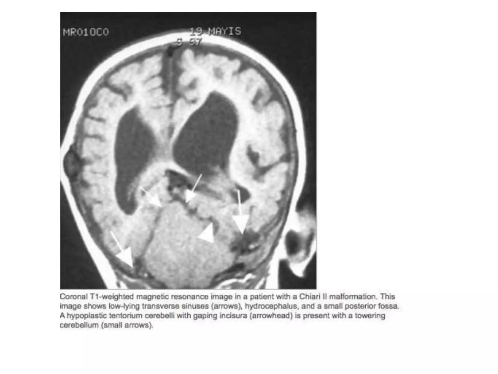 chiari malformation mukesh.pptx
