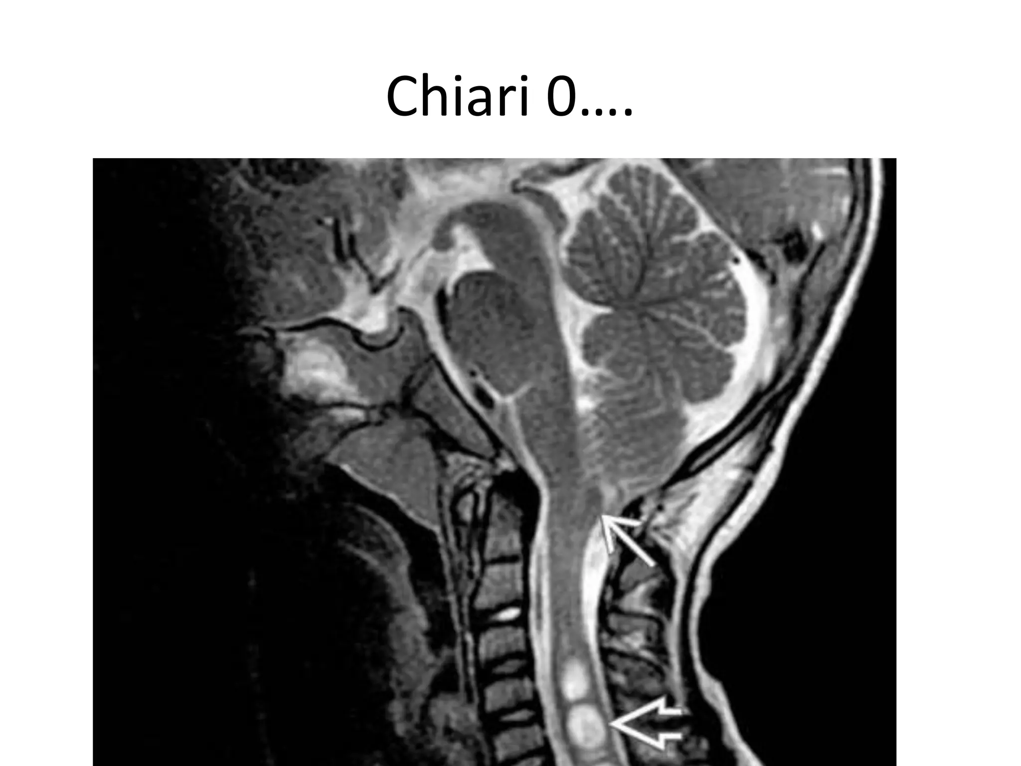chiari malformation mukesh.pptx