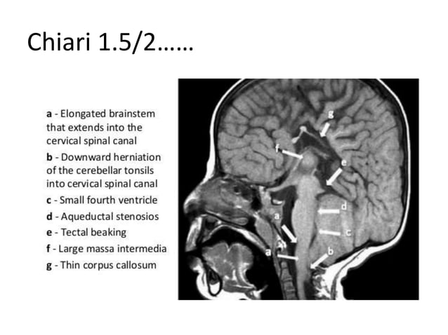 chiari malformation mukesh.pptx