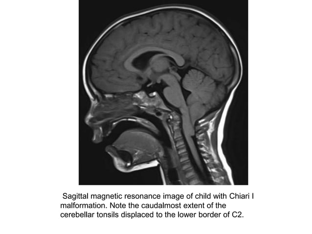 chiari malformation mukesh.pptx