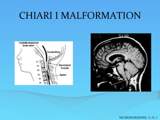 Chiari Malformations By Eric Trumble, MD | PPT | Death, Injury, or ...