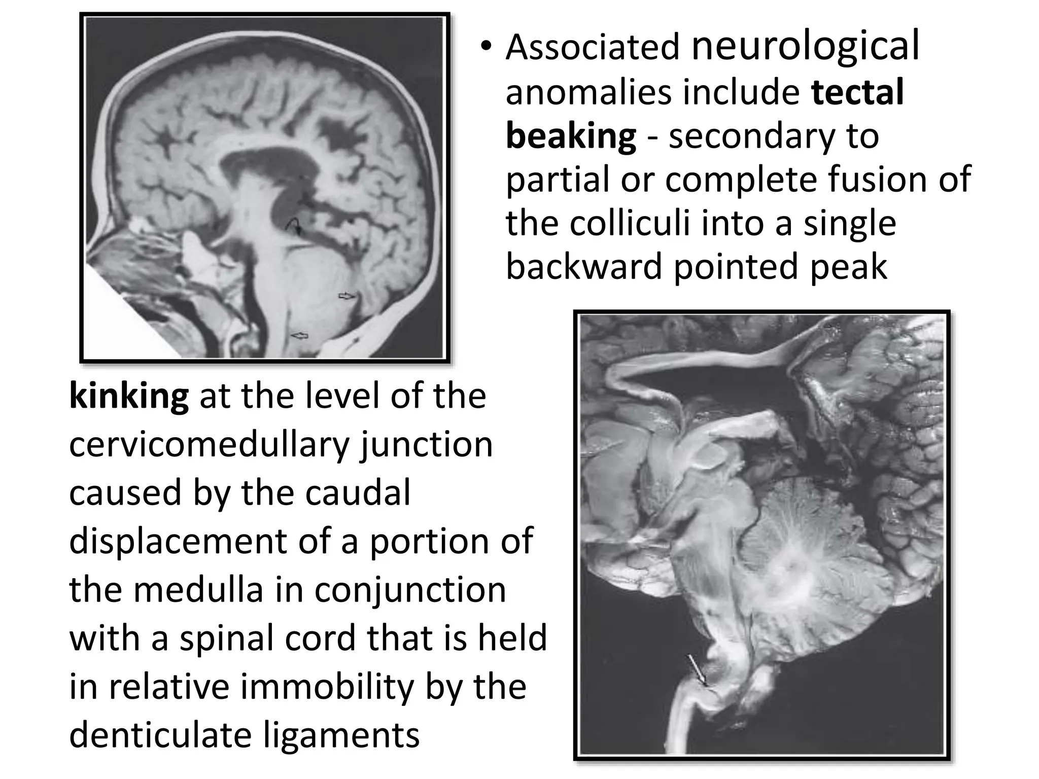 Chiari Malformations.pptx