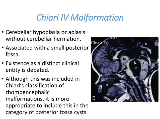 Chiari Malformations.pptx