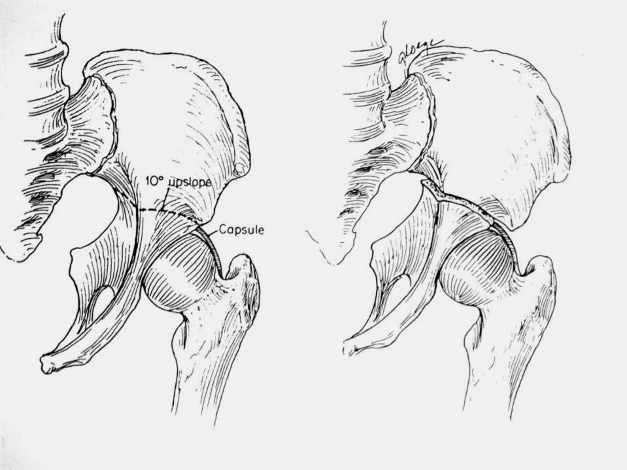 Chiari pelvic osteotomy | PPTX