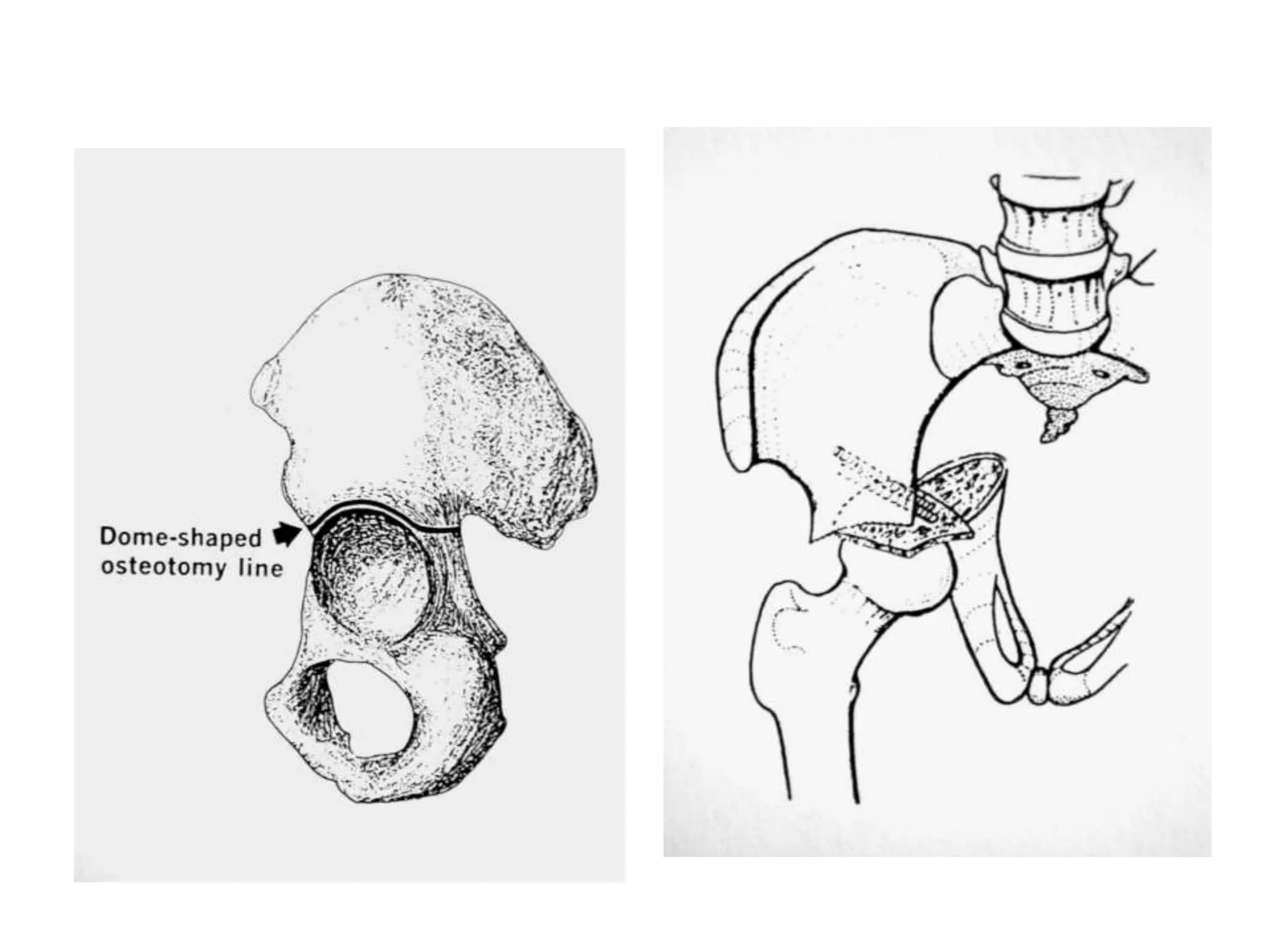 Chiari pelvic osteotomy | PPTX