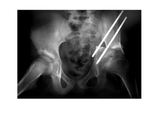 Chiari pelvic osteotomy | PPTX