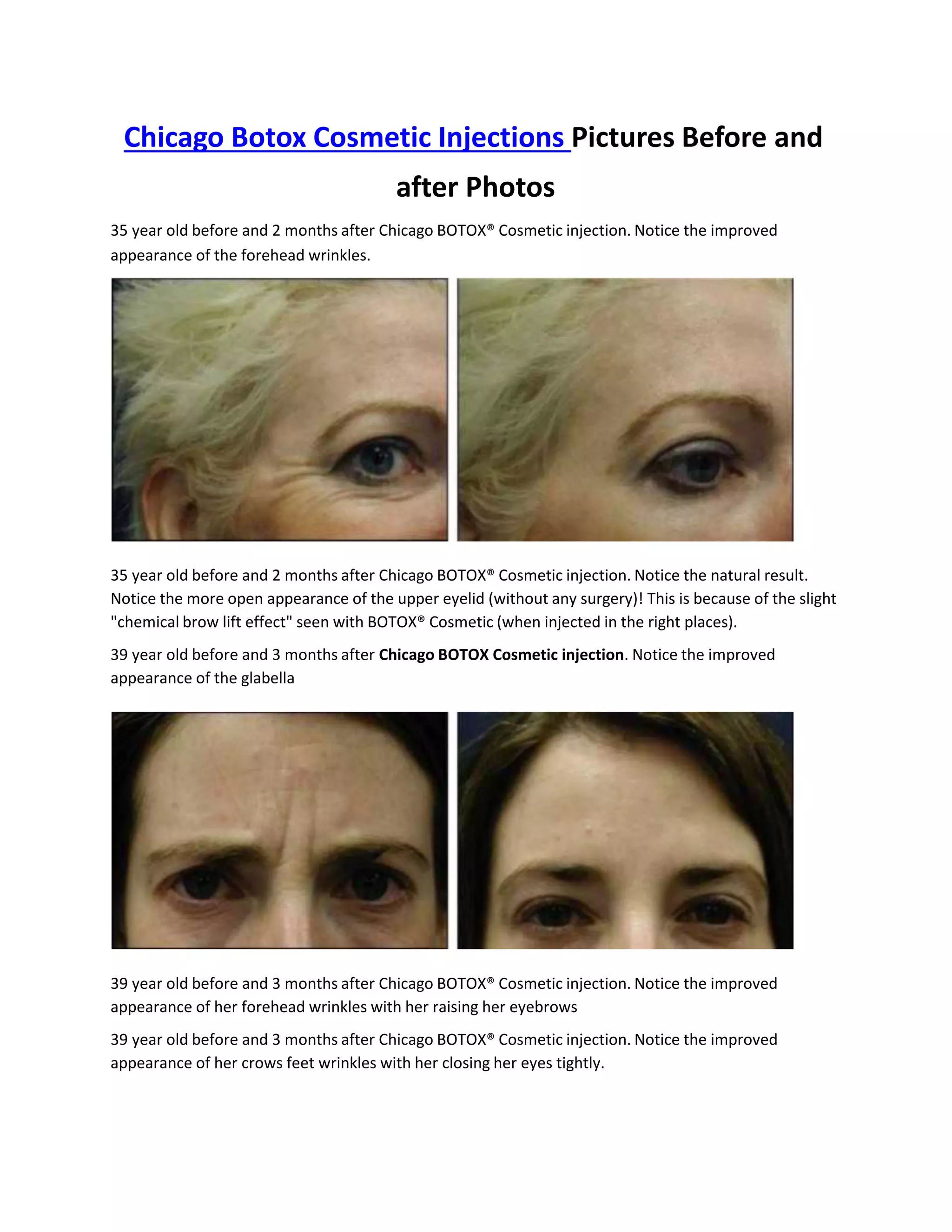 Chicago Botox Cosmetic Injections Pictures Before and After Photos ...