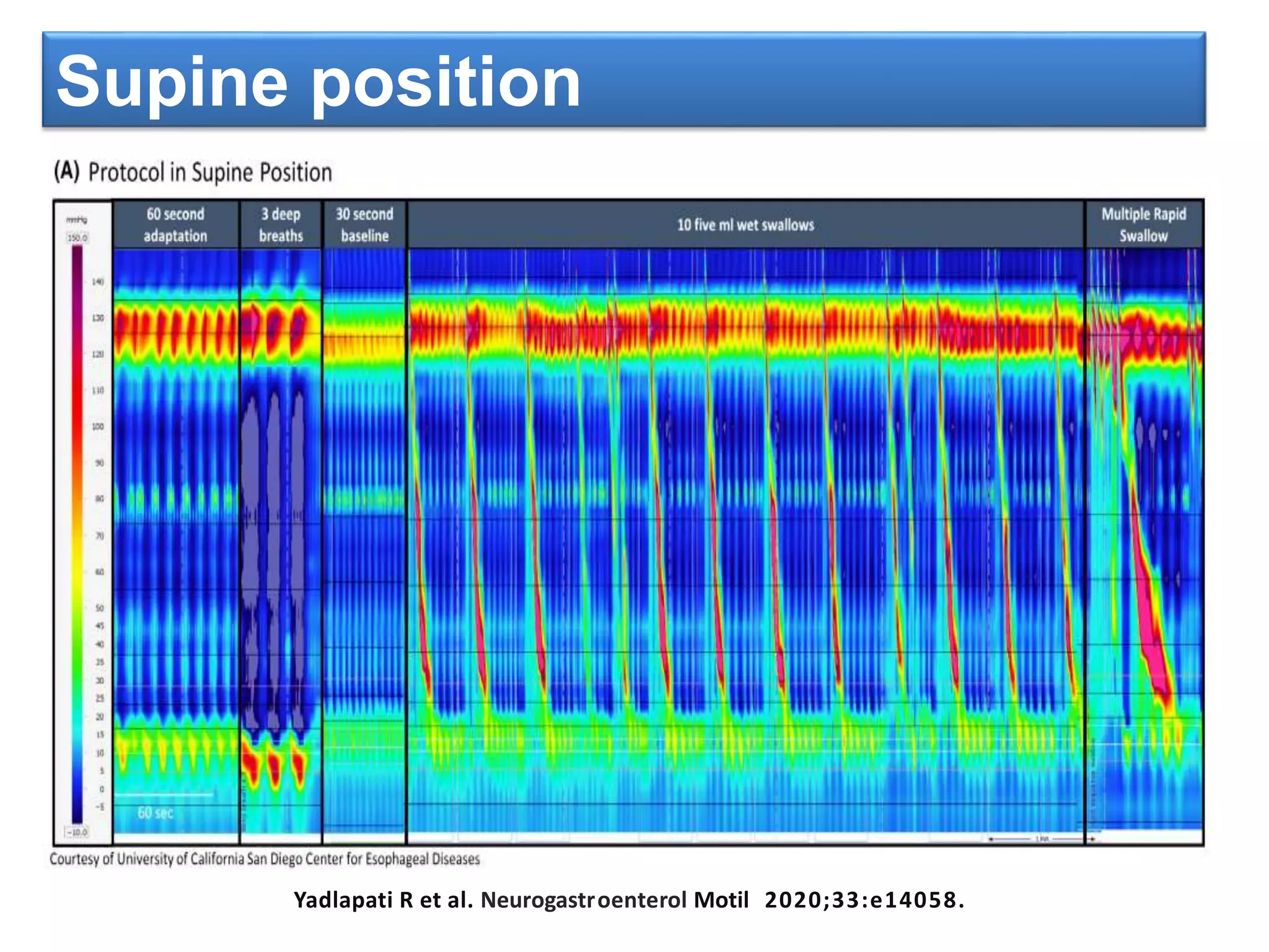 Chicago classification version 4.0: HRM classification of esophageal ...