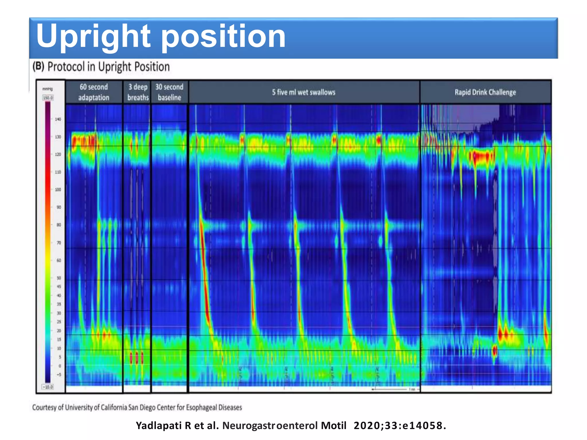 Chicago classification version 4.0: HRM classification of esophageal ...