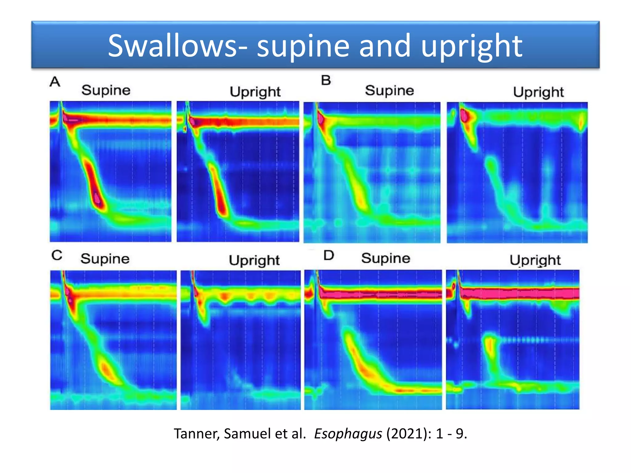 Chicago classification version 4.0: HRM classification of esophageal ...