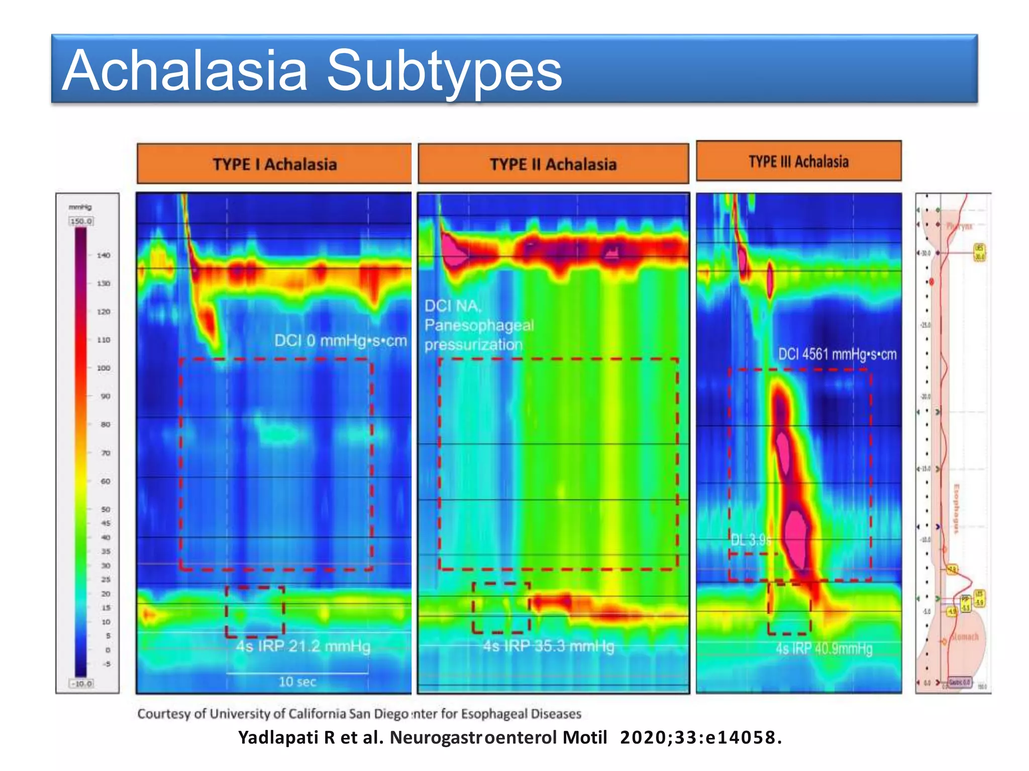 Chicago classification version 4.0: HRM classification of esophageal ...