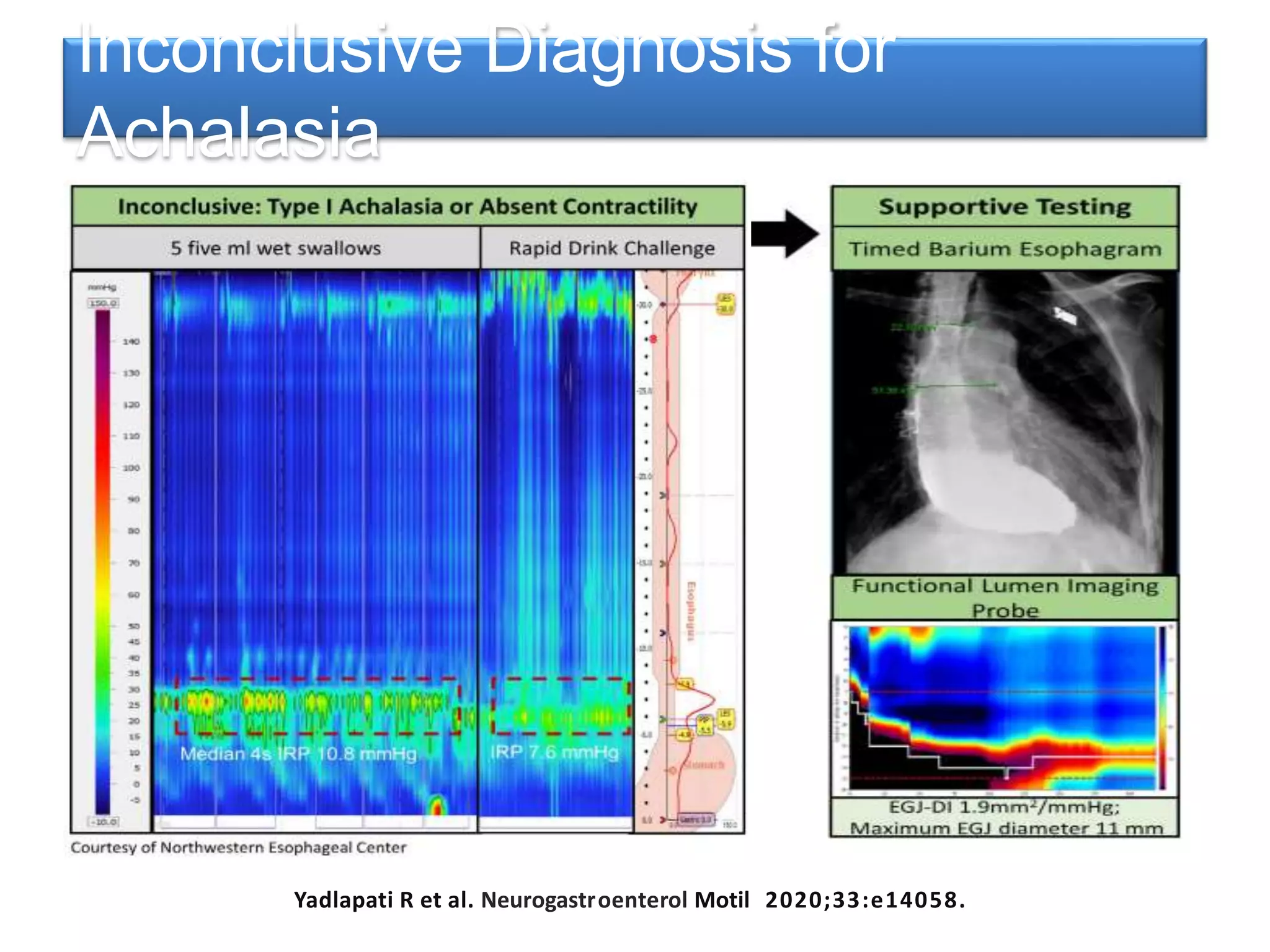 Chicago classification version 4.0: HRM classification of esophageal ...