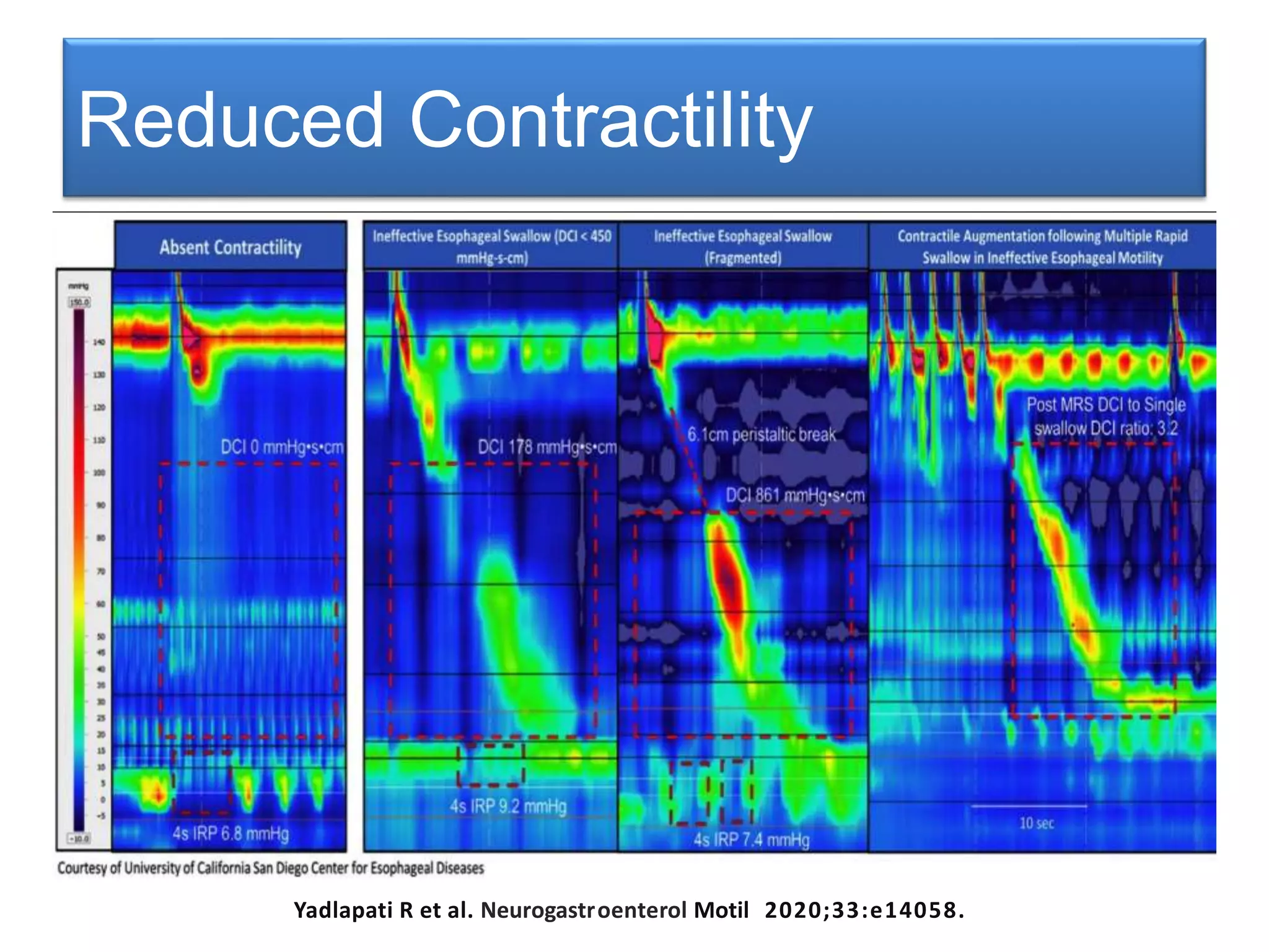 Chicago classification version 4.0: HRM classification of esophageal ...