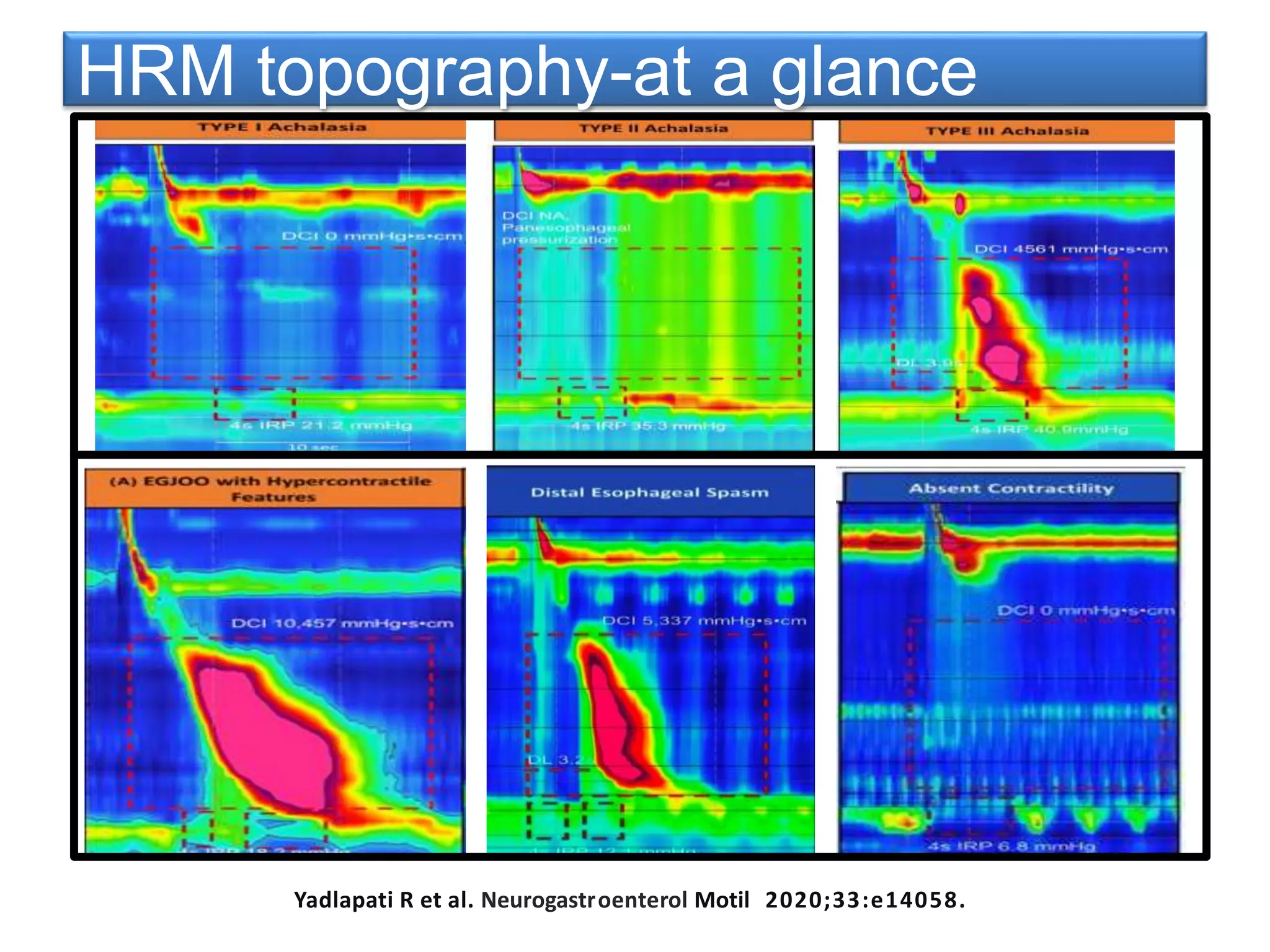 Chicago classification version 4.0: HRM classification of esophageal ...