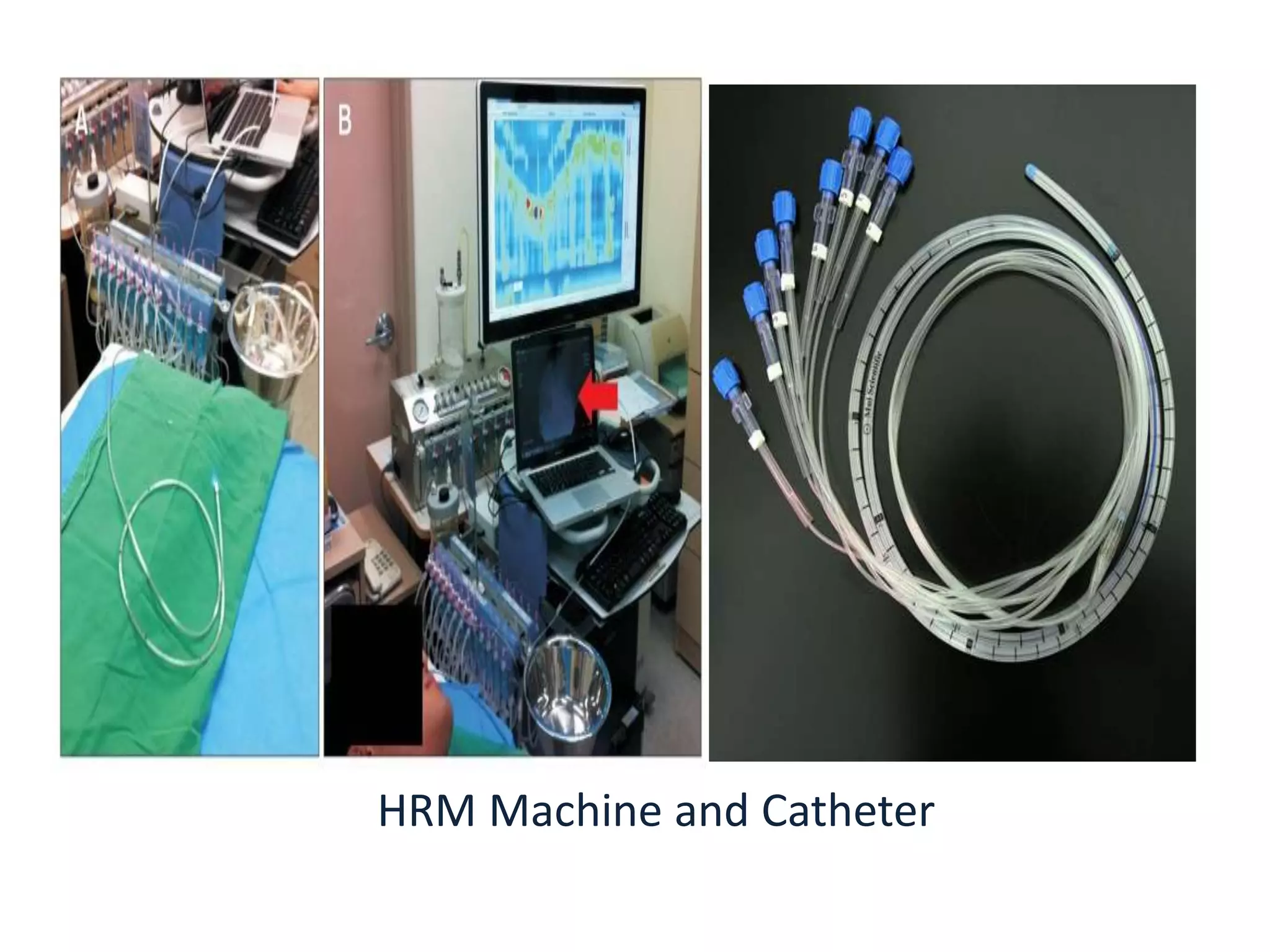 Chicago classification version 4.0: HRM classification of esophageal ...