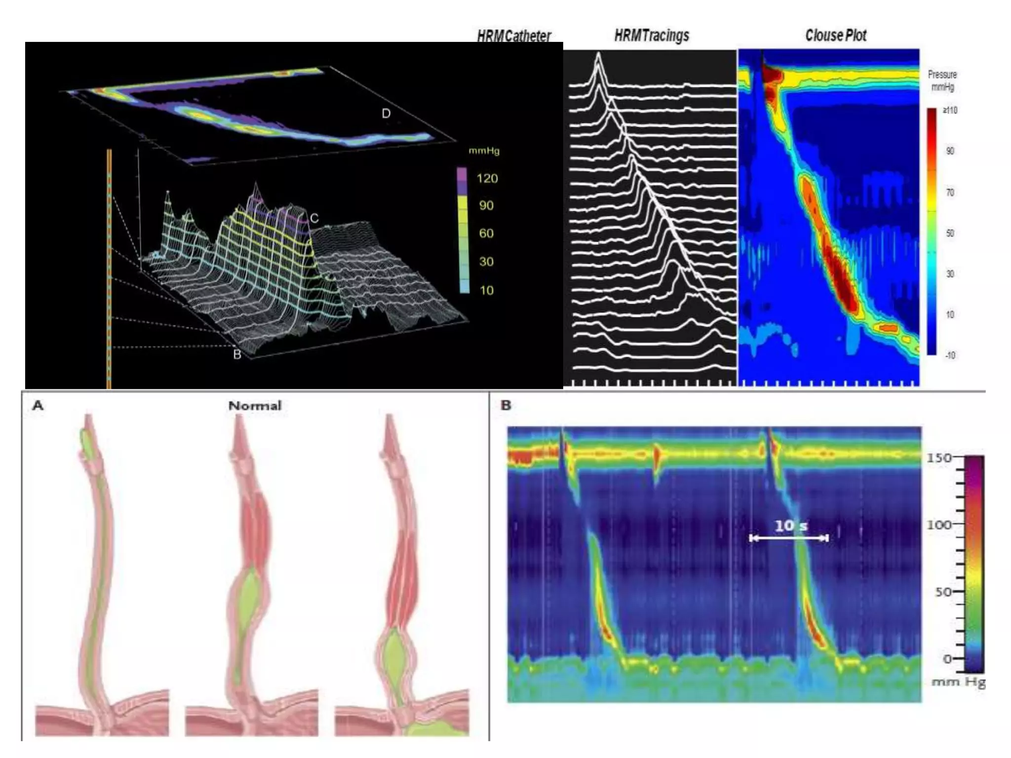 Chicago classification version 4.0: HRM classification of esophageal ...