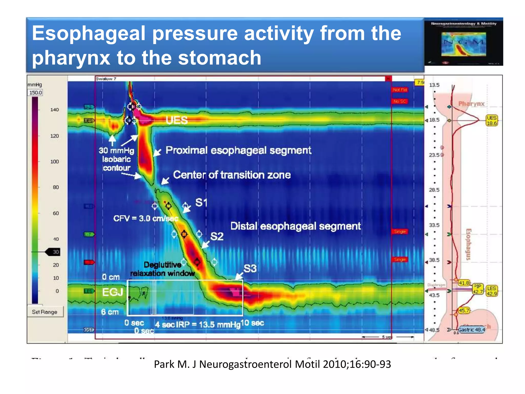 Chicago classification version 4.0: HRM classification of esophageal ...