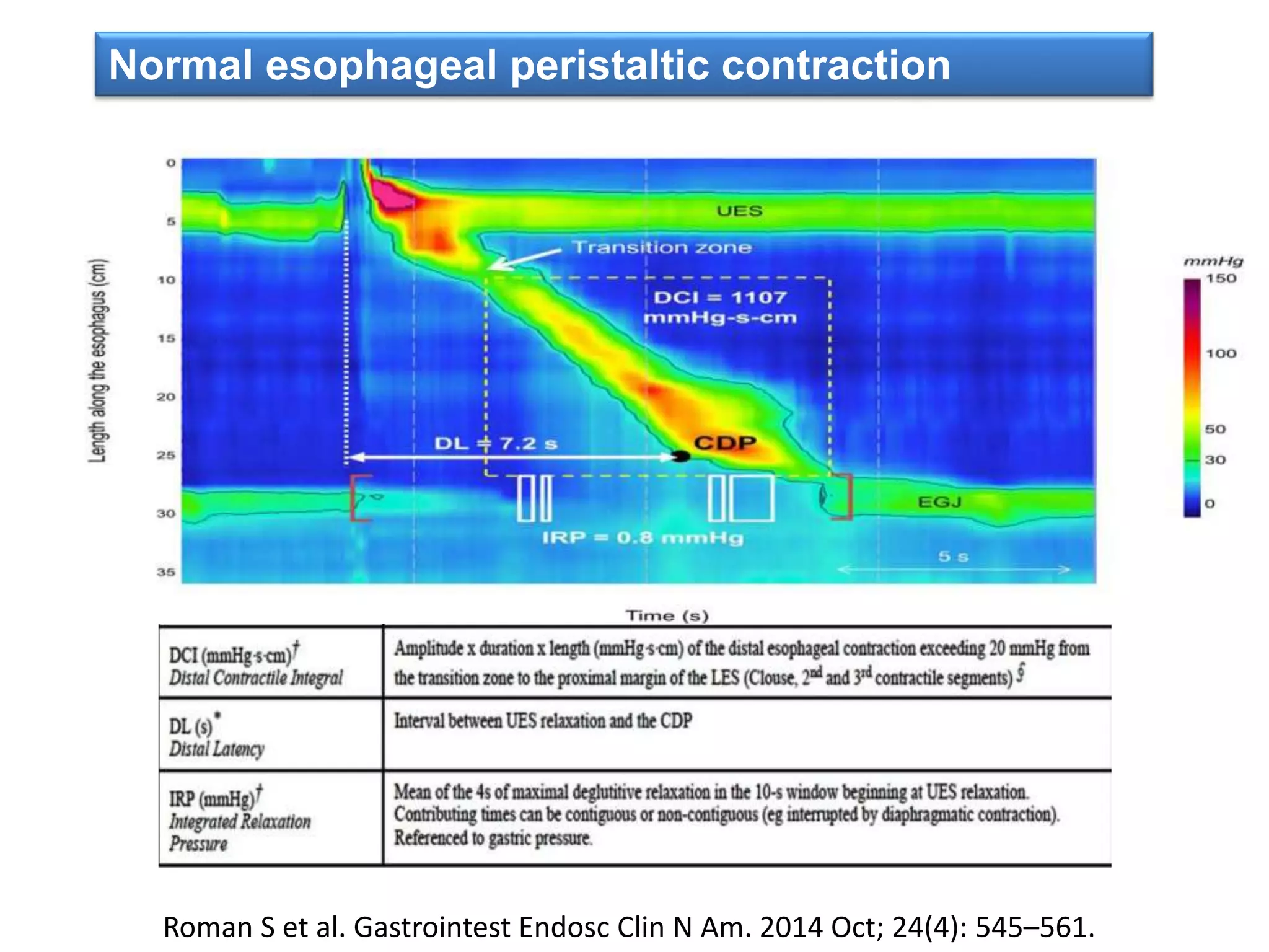 Chicago classification version 4.0: HRM classification of esophageal ...