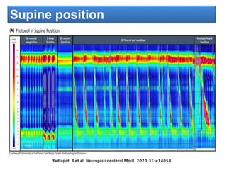 Chicago classification version 4.0: HRM classification of esophageal ...