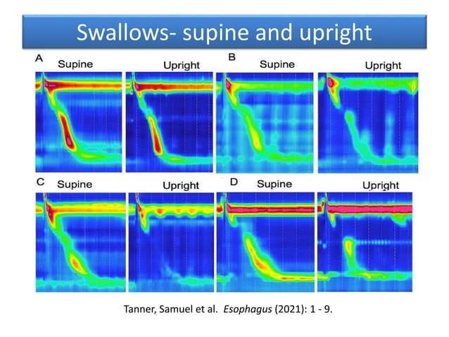 Chicago classification version 4.0: HRM classification of esophageal ...