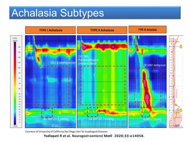 Chicago classification version 4.0: HRM classification of esophageal ...